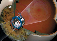 Ophthalmology Times - Telescope may serve as permanent prosthesis for ...