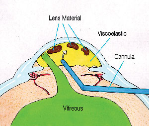 Review of Ophthalmology